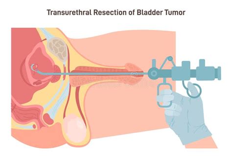 Transurethral Resection Of The Bladder Tumor Male Bladder Benign Stock Vector Illustration Of