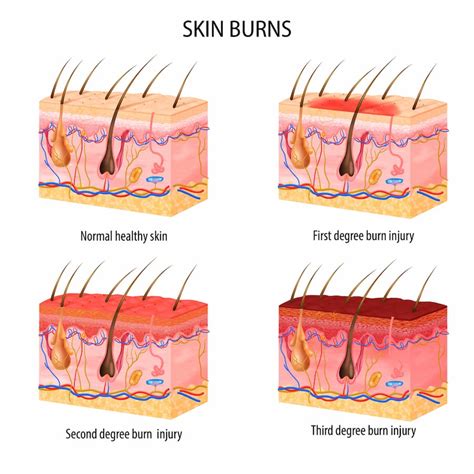 Stem Cell For Burns Treatment Swiss Medica