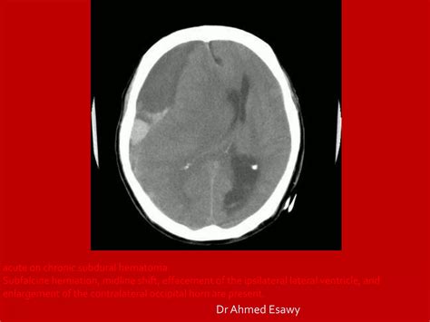 Full Story Brain Herniation Imaging Dr Ahmed Esawy Pdf