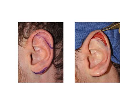Vertical Ear Reduction Technique Scapha Reduction Dr Barry Eppley Indianapolis Explore
