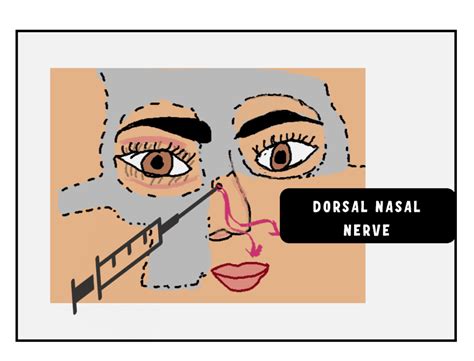 Nerve Blocks For Lacrimal Sac Surgeries A Comprehensive Guide Insight Ophthalmology