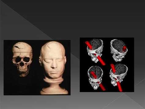 Pyramidal Tract And Extra Pyramidal Tracts Pptx
