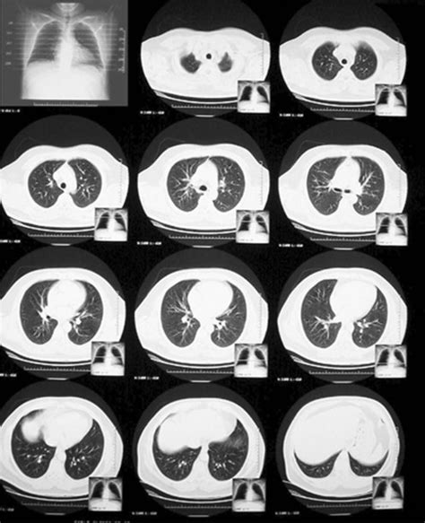 Radiologic Examination Of The Chest Clinical Gate