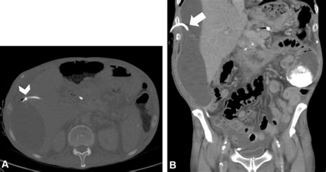 Biliary Leaks Multidisciplinary Approach To Diagnosis And Treatment
