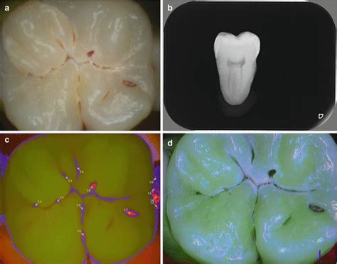 New Caries Diagnostic Methods Pocket Dentistry