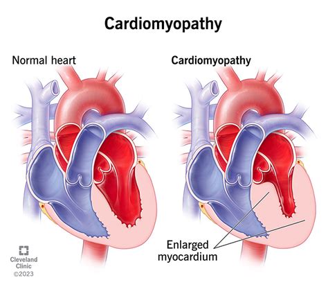 Types Of Hypertrophic Cardiomyopathy Leo Löwchen