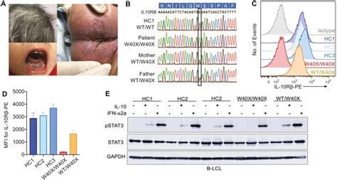 Clinical And Cellular Phenotypes Resulting From A Founder Mutation In