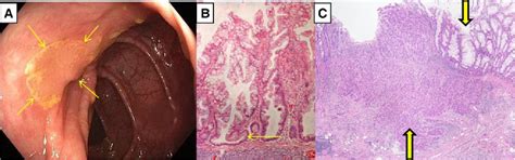 Figure 1 From Sessile Serrated Polyps And Colon Cancer Prevention Semantic Scholar