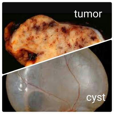 Difference Between Cyst And Tumor Cyst And Tumor Both Of Them Are Bad