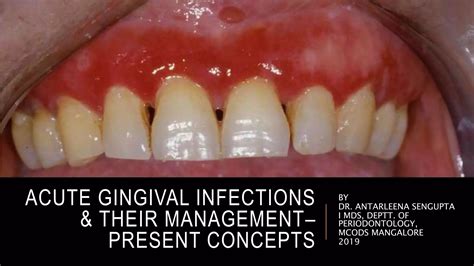 Acute Gingival Infections Pptx