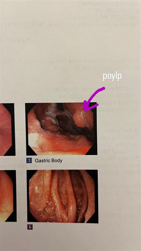Morning Endoscopy Results Rmedizzy