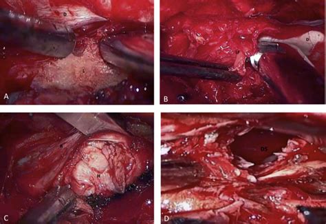 Intraoperative Images A Hemilaminectomy B Flavectomy C Download Scientific Diagram