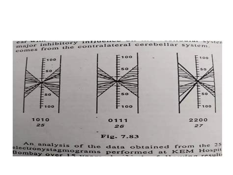 Electronystagmography Pptx