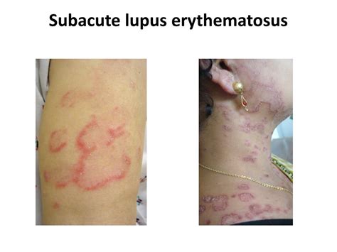 Ppt Lupus Erythematosus Powerpoint Presentation Free Download Id