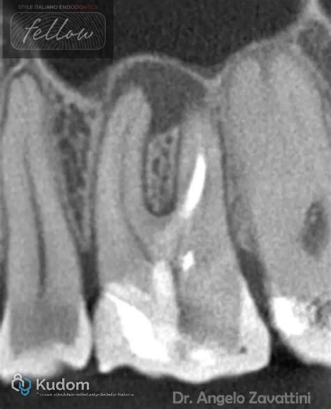 Selective Root Canal Retreatment Of An Upper First Molar A 12 Months