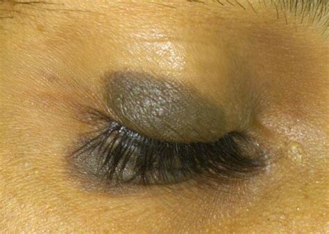 Kissing Naevus Of Eyelid Presenting As Velvety Plaque Download