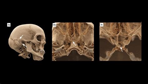 Traumatic Incudomalleolar Dislocation Siemens Healthineers