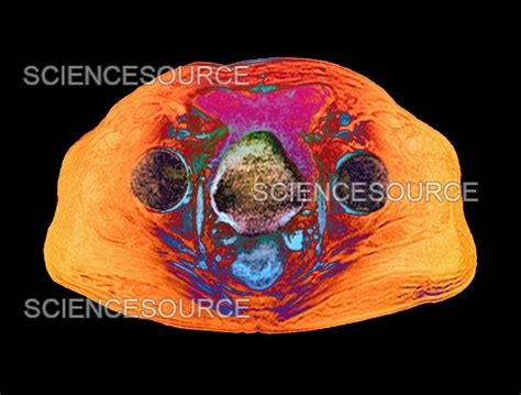 Prostate Cancer Mri Stock Image Science Source Images