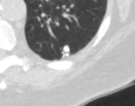 Tree In Bud Sign The Common Vein