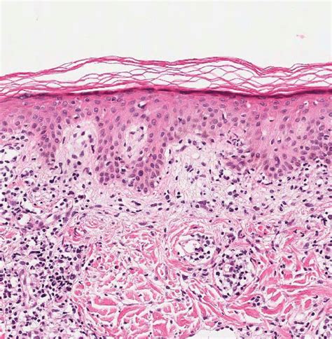 A Lymphohistiocytic Infiltration Along Dermoepidermal Junction And Download Scientific