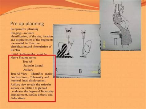 Fracture Proximal Humerus Fixation With K Wires And External Fixator Pptx
