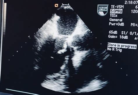 Postop Echo Showing Mitral Annulus After Mitral Annuloplasty With An Ef