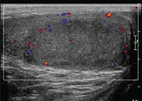 A B Us Demonstrate A 24×16×37 Cm Left Intratesticular