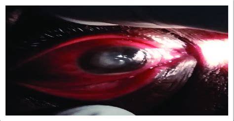 Right Eye Examination Showing Hypopyon Corneal Ulcer Measuring 55 X 4 Download Scientific