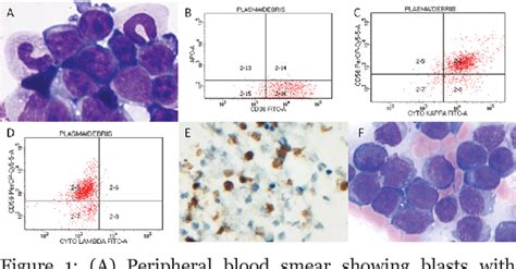 Figure 1 From Acute Plasmablastic Leukemia A Diagnostic Challenge