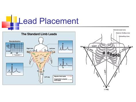 Ecg Interpretation Ppt