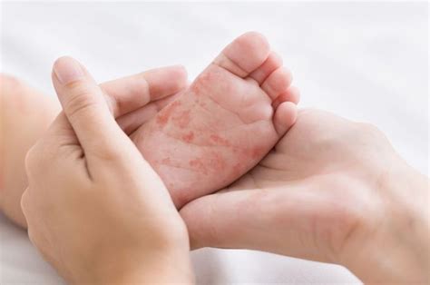 Kasus Campak Meningkat Berikut Ini Ciri Dan Pengobatan Penyakit Campak Sonora Id