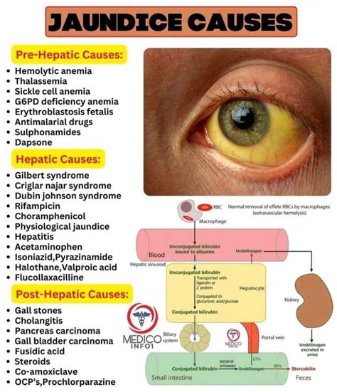 Understanding Jaundice Causes Symptoms Diagnosis And Treatment Dr