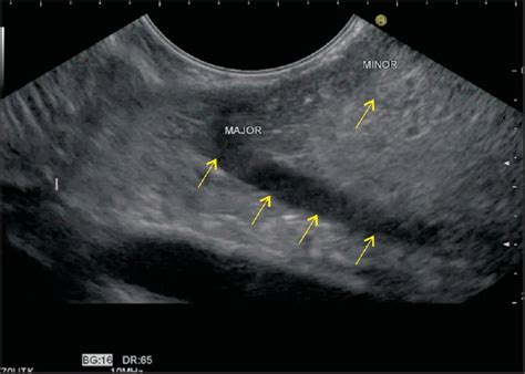 Pancreatic Divisum Ultrasound