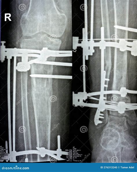 Comminuted Fracture X Ray