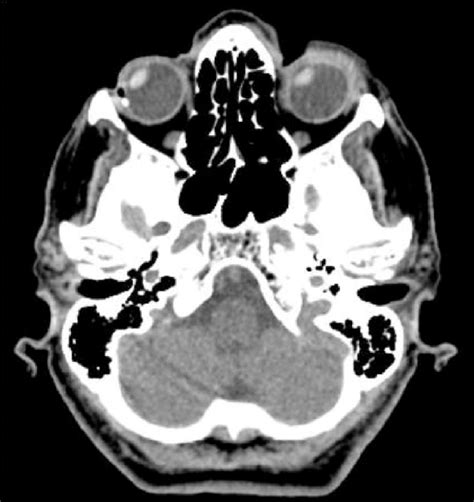 Non Contrast Computed Tomography Ct Scan Showing Conjugate Eye