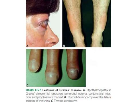 Hyperthyroidism About Goiter Medical Pptpptx