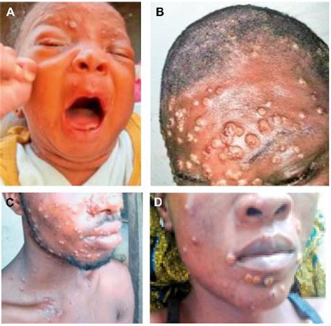 Skin Manifestation Of Human Monkeypox