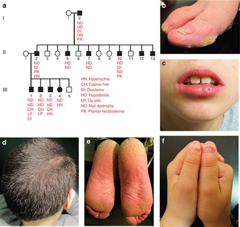 A Mutation In Tp63 Causing A Mild Ectodermal Dysplasia Phenotype