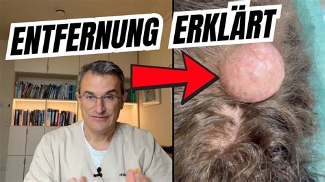 🧠 Zyste Am Kopf So Läuft Die Schonende Entfernung Ab Youtube