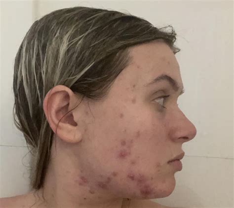 3 Weeks In 60mg Raccutane