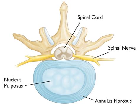 Herniated Disk In The Lower Back Orthoinfo Aaos