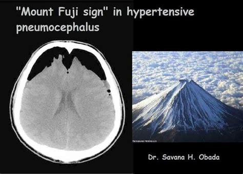 26 Best Caudate Nucleus Ideas Caudate Nucleus Radiology Imaging