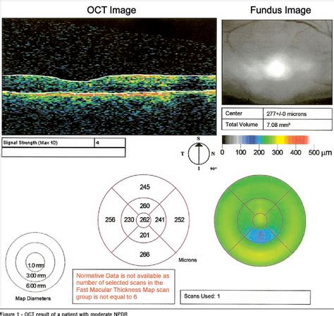 Normal Macular Thickness