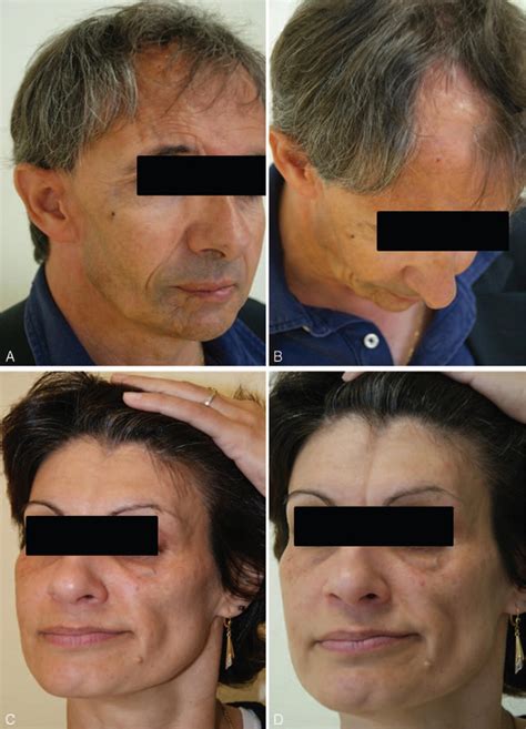 Case 1 A And B Right Facial Atrophy With Frontal Linear Scleroderma