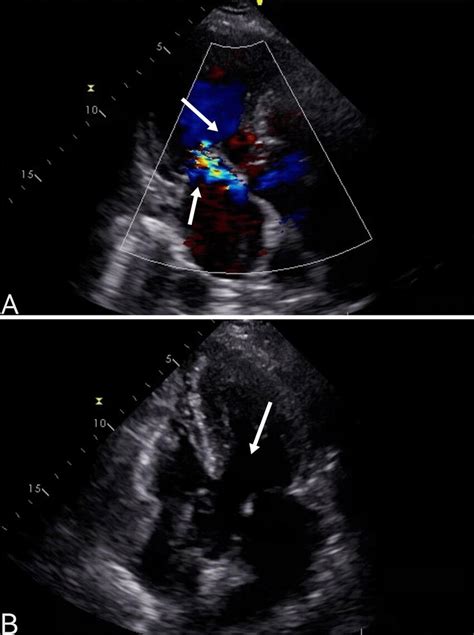 Echocardiography Postoperatively The Mitral Valve Regurgitation Was