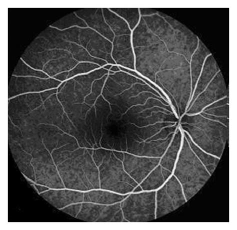 Diabetic Macular Edema Fluorescein Angiography