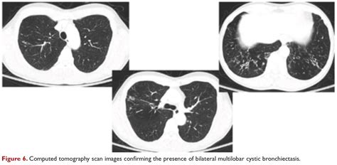 Nontuberculous Mycobacterial Pulmonary Disease Mdedge