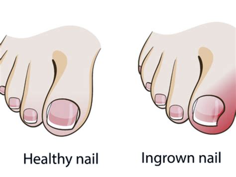 How To Treat An Infected Ingrown Toenail