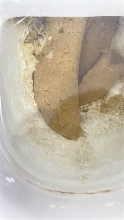 Is This Flat Stool And Is It Serious Or Normal What Ia This Black