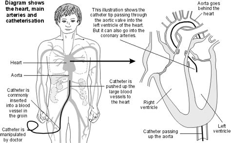 Cardiac Catheterisation For Heart Problems